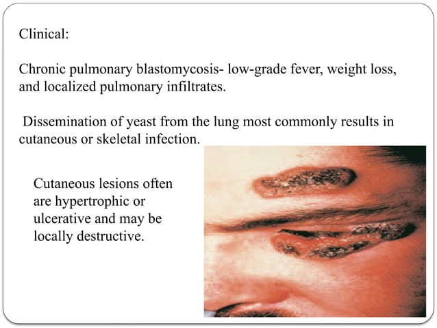DEEP FUNGAL INFECTIONS-Candida, Aspergillus | PPTX