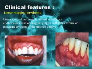viruses in periodontal disease | PPTX