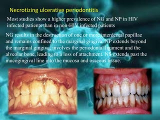 viruses in periodontal disease | PPTX