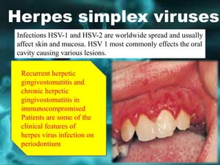 viruses in periodontal disease | PPTX