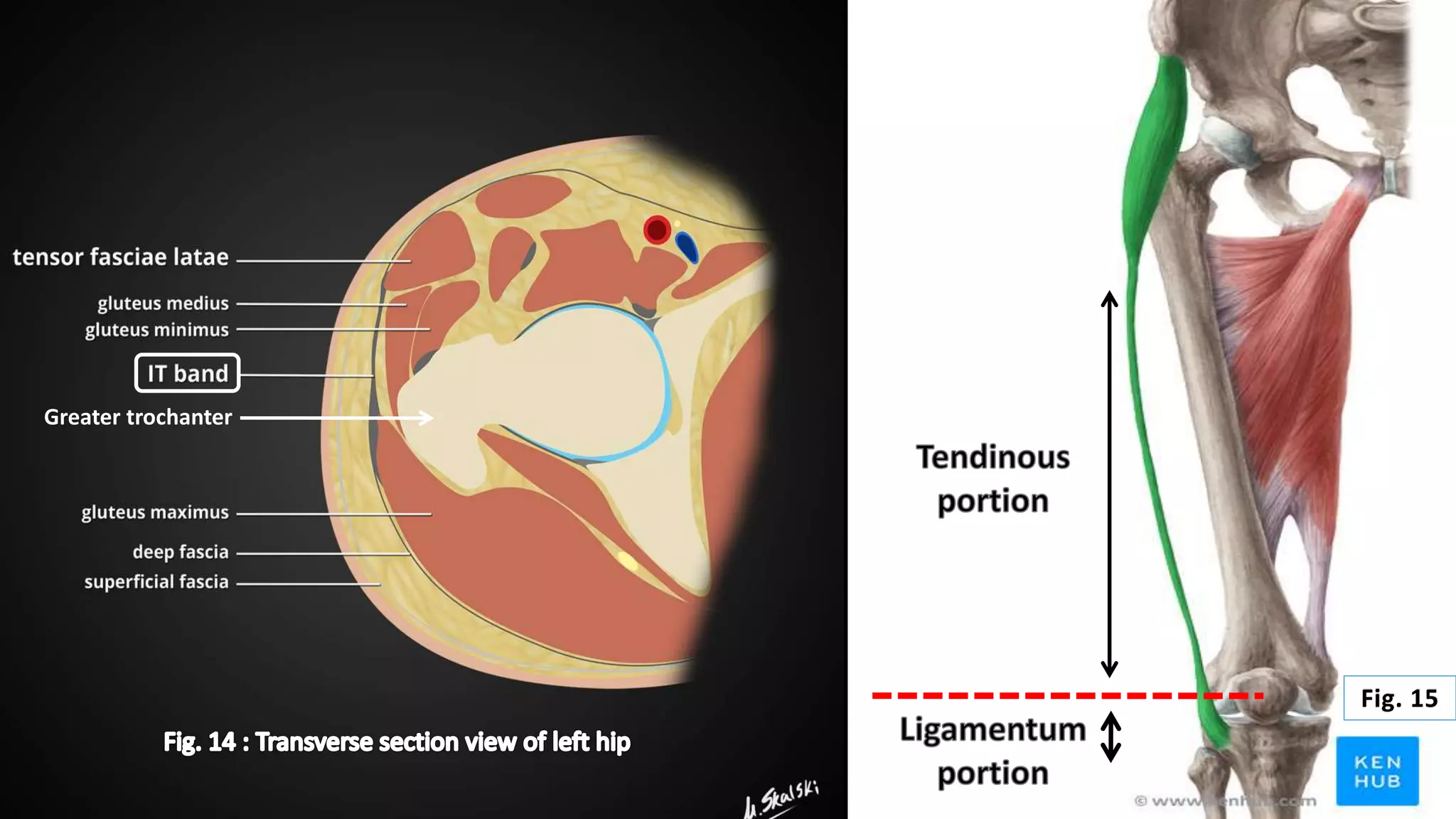 Deep layer of (Iliotibial) IT band | PPTX