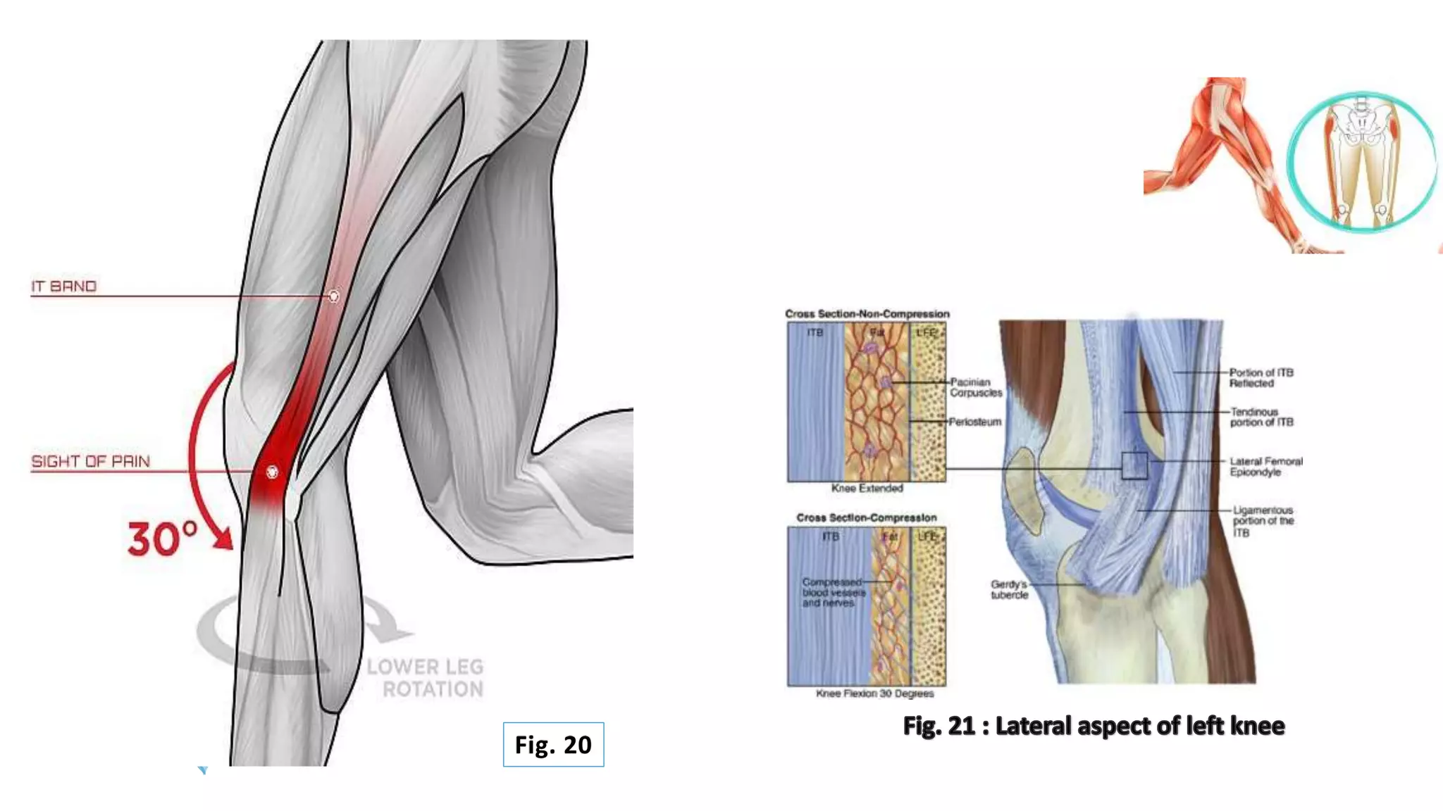 Deep layer of (Iliotibial) IT band | PPTX