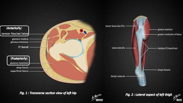 Deep layer of (Iliotibial) IT band | PPTX