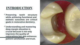 Deep margin elevation in class II cavities.pptx