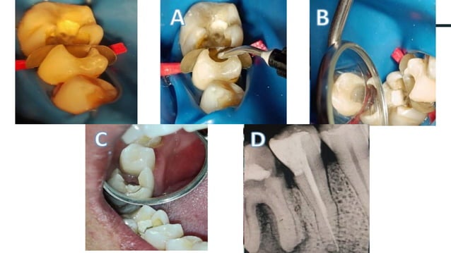 Deep margin elevation in class II cavities.pptx