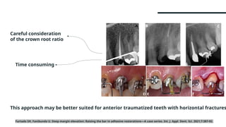 Deep margin elevation in class II cavities.pptx