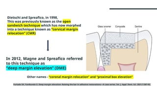 Deep margin elevation in class II cavities.pptx