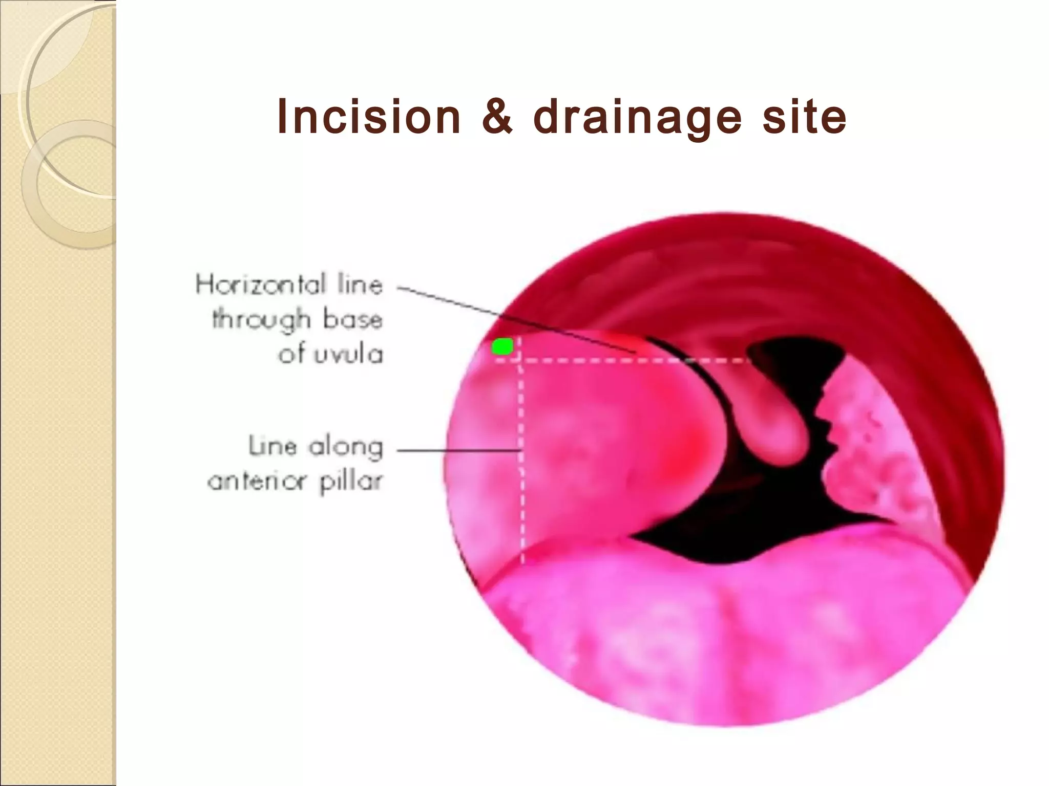 Deep neck infection | PPT