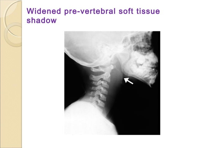 Deep neck infection | PPT | Ear, Nose and Throat Conditions | Diseases ...