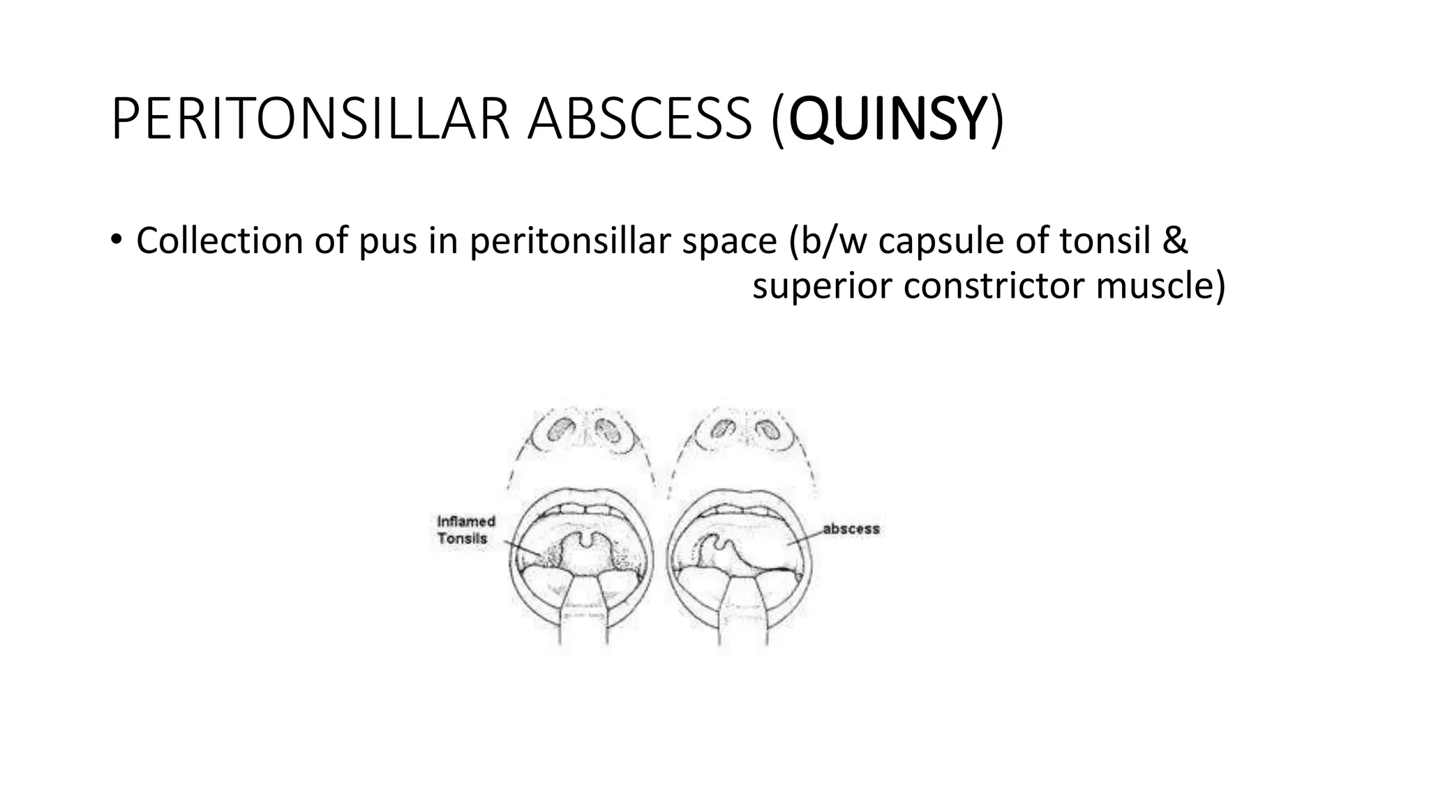Deep neck space infection ENT REVISION NOTES | PPTX