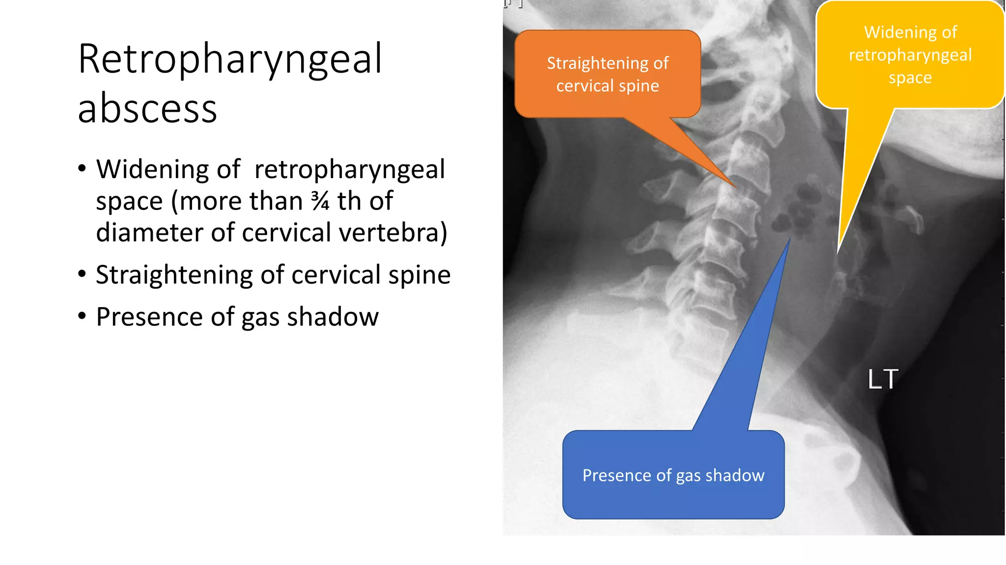 Deep neck space infection ENT REVISION NOTES | PPTX