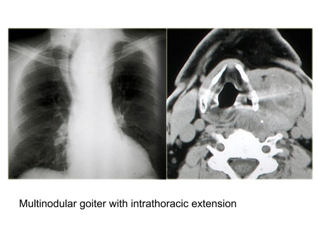 Diagnostic Imaging of Deep Neck Spaces | PPT | Thyroid Disorders ...