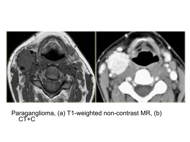 Diagnostic Imaging of Deep Neck Spaces | PPT | Thyroid Disorders ...