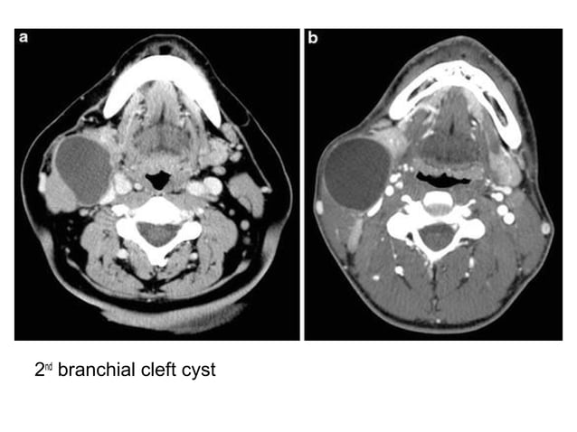 Diagnostic Imaging of Deep Neck Spaces | PPT | Thyroid Disorders ...