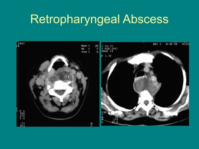 Deep space neck infection . | PPT