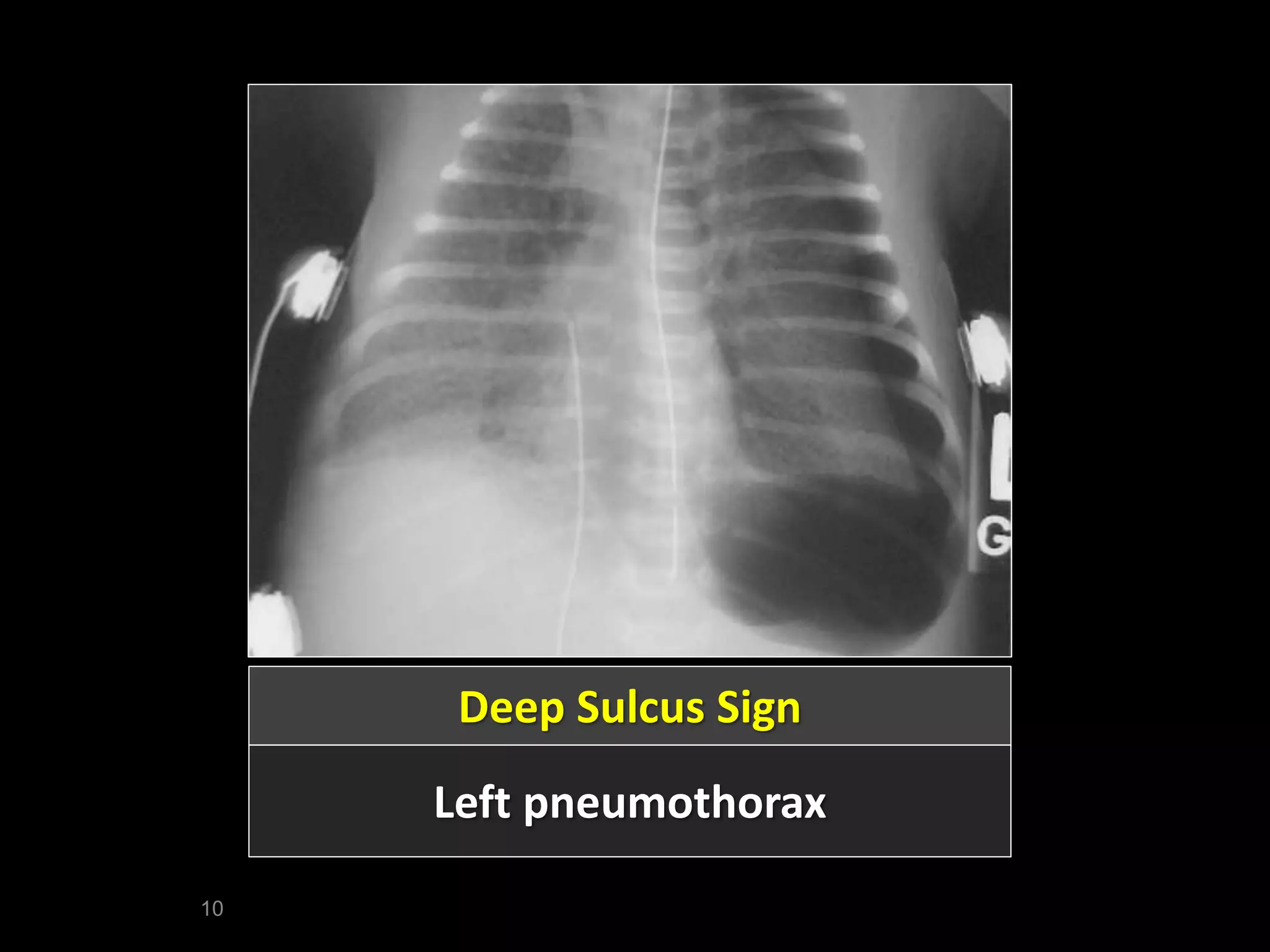 Deep sulcus sign fallen lung sign-ct angiogram sign-flat-waist sign | PPTX