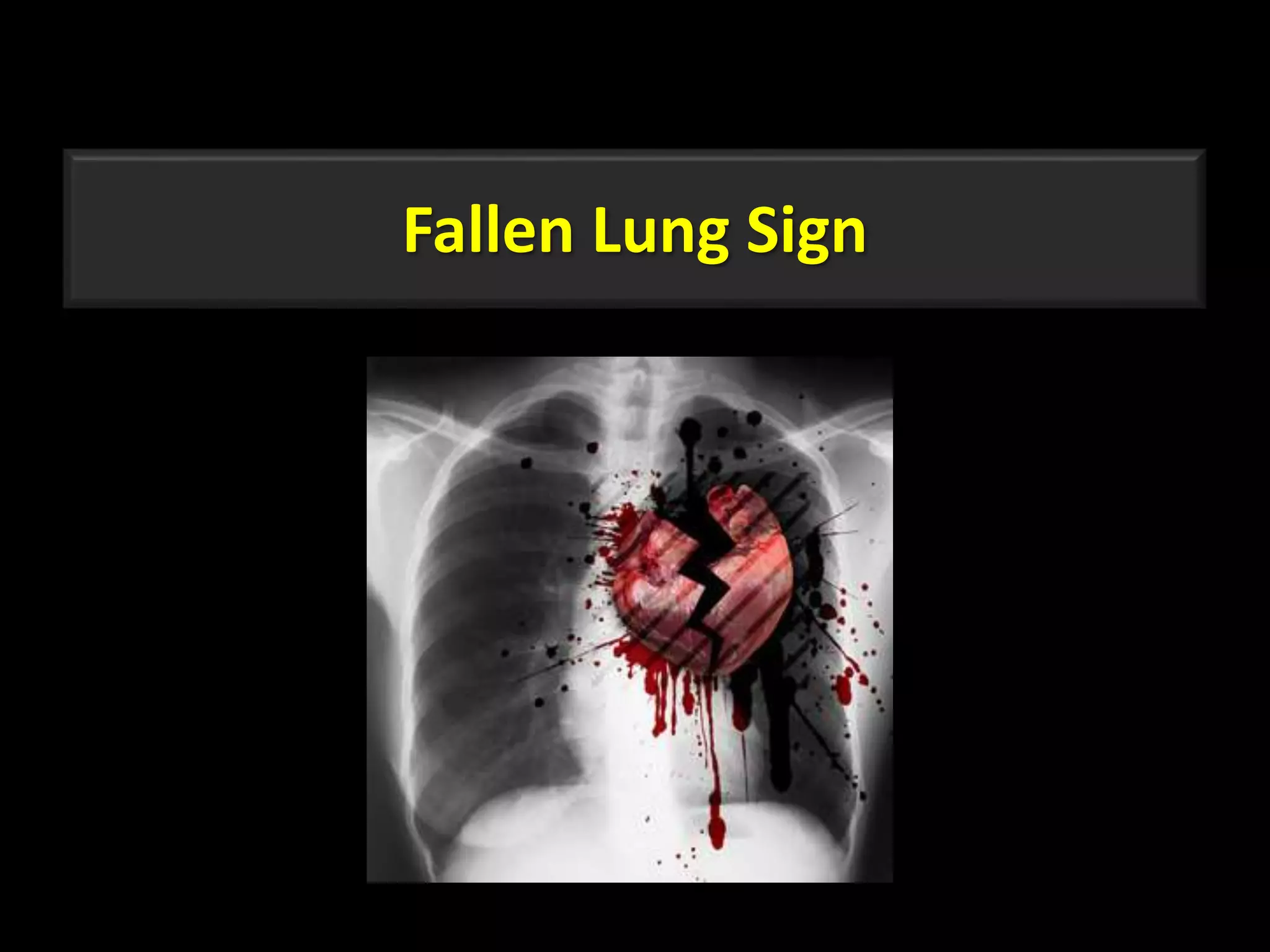 Deep sulcus sign fallen lung sign-ct angiogram sign-flat-waist sign | PPTX