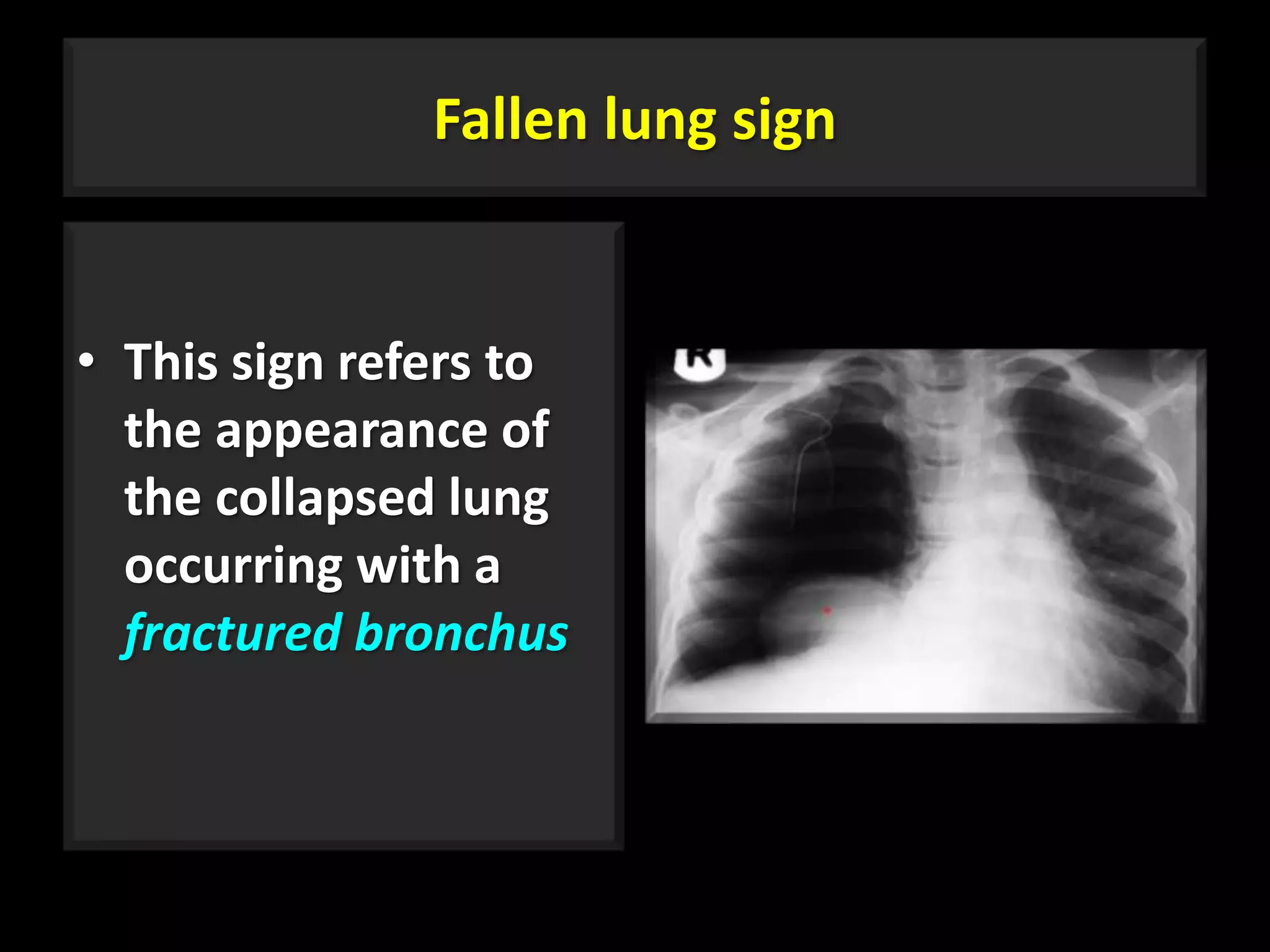 Deep sulcus sign fallen lung sign-ct angiogram sign-flat-waist sign | PPTX