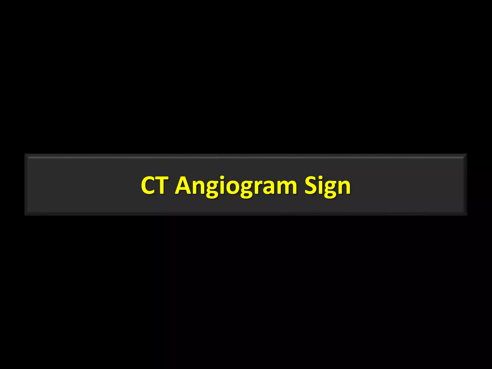 Deep sulcus sign fallen lung sign-ct angiogram sign-flat-waist sign | PPTX
