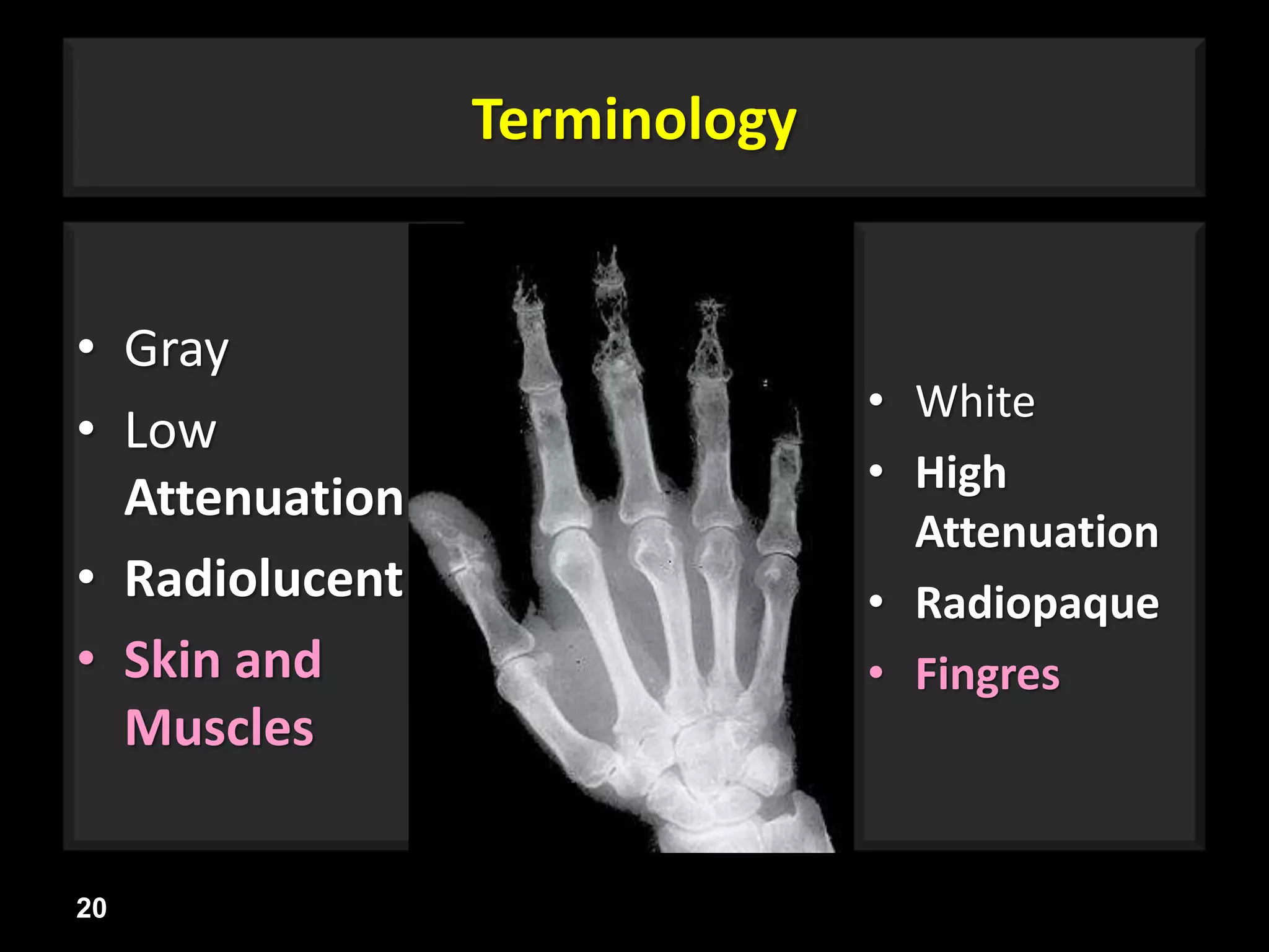 Deep sulcus sign fallen lung sign-ct angiogram sign-flat-waist sign | PPTX