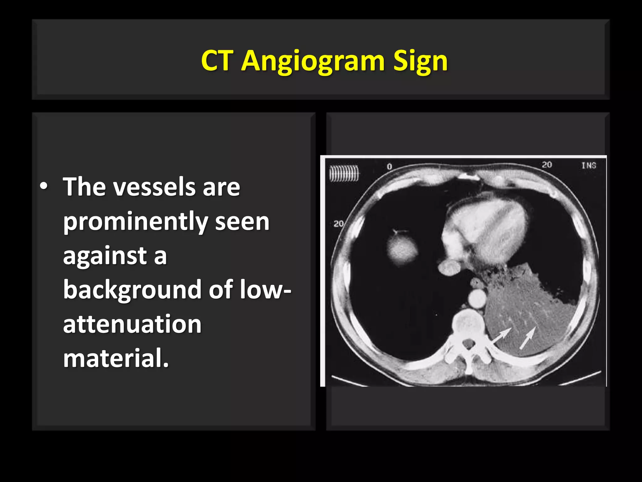 Deep sulcus sign fallen lung sign-ct angiogram sign-flat-waist sign | PPTX