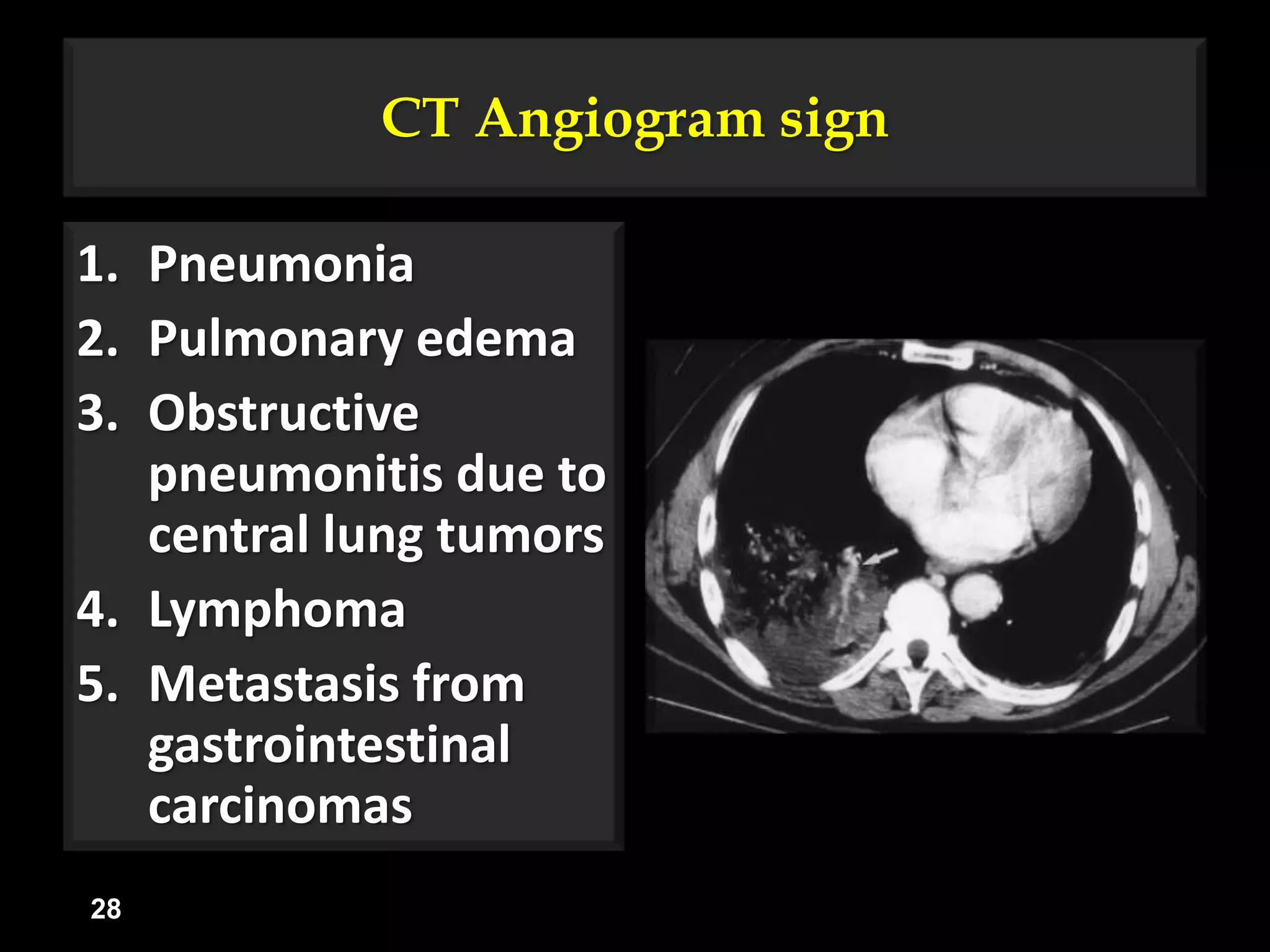 Deep sulcus sign fallen lung sign-ct angiogram sign-flat-waist sign | PPTX