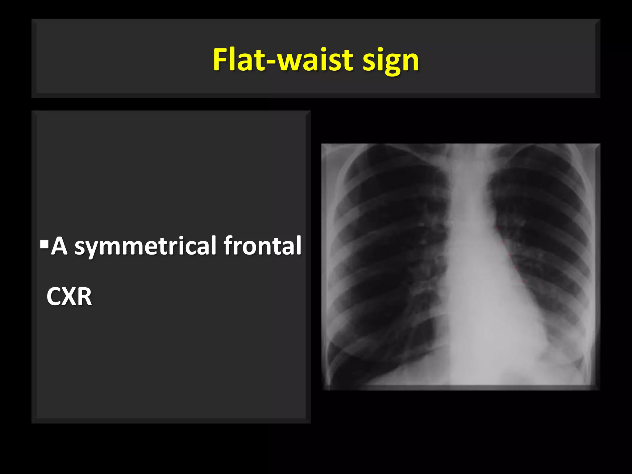 Deep sulcus sign fallen lung sign-ct angiogram sign-flat-waist sign | PPTX