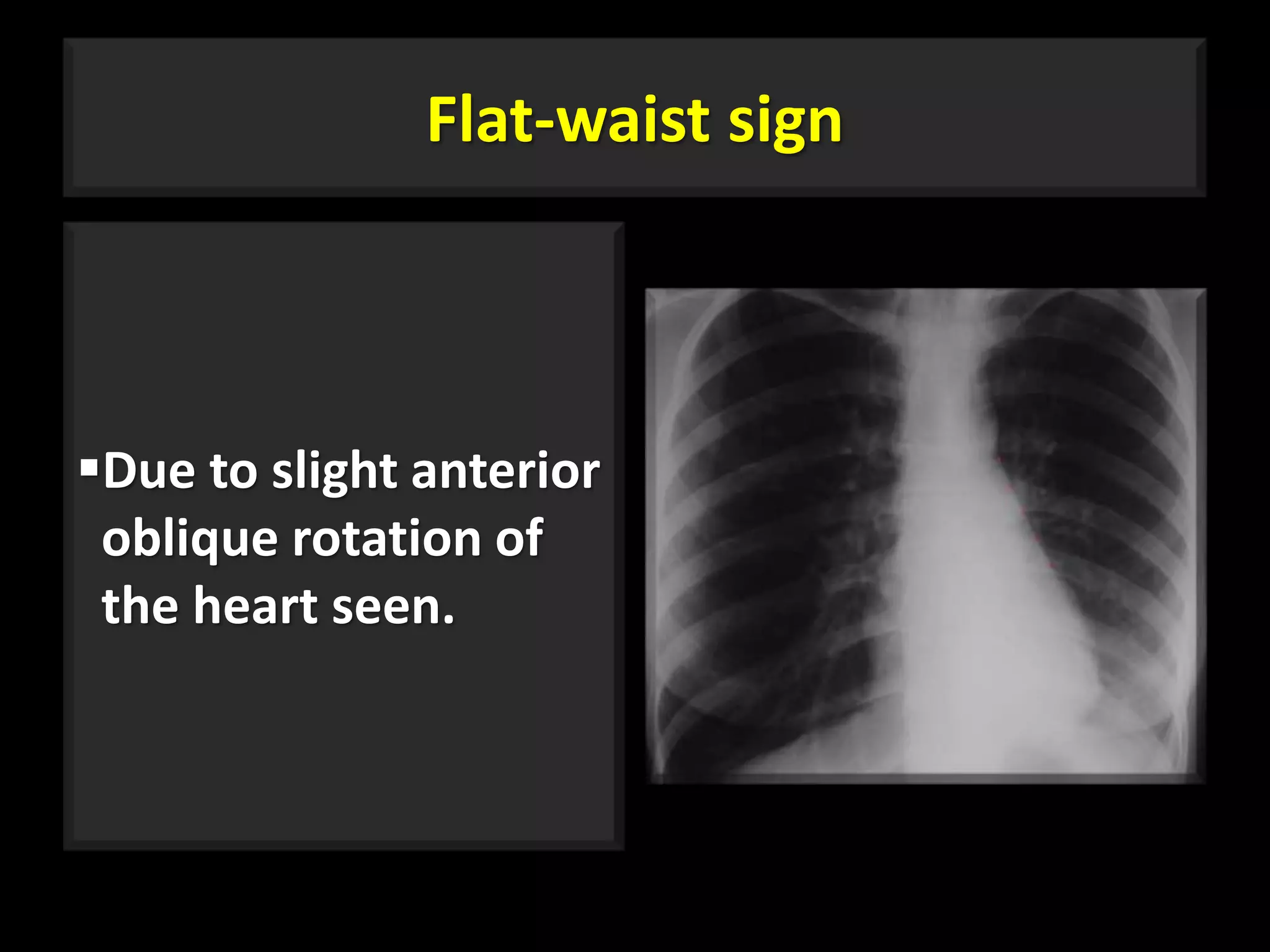 Deep sulcus sign fallen lung sign-ct angiogram sign-flat-waist sign | PPTX