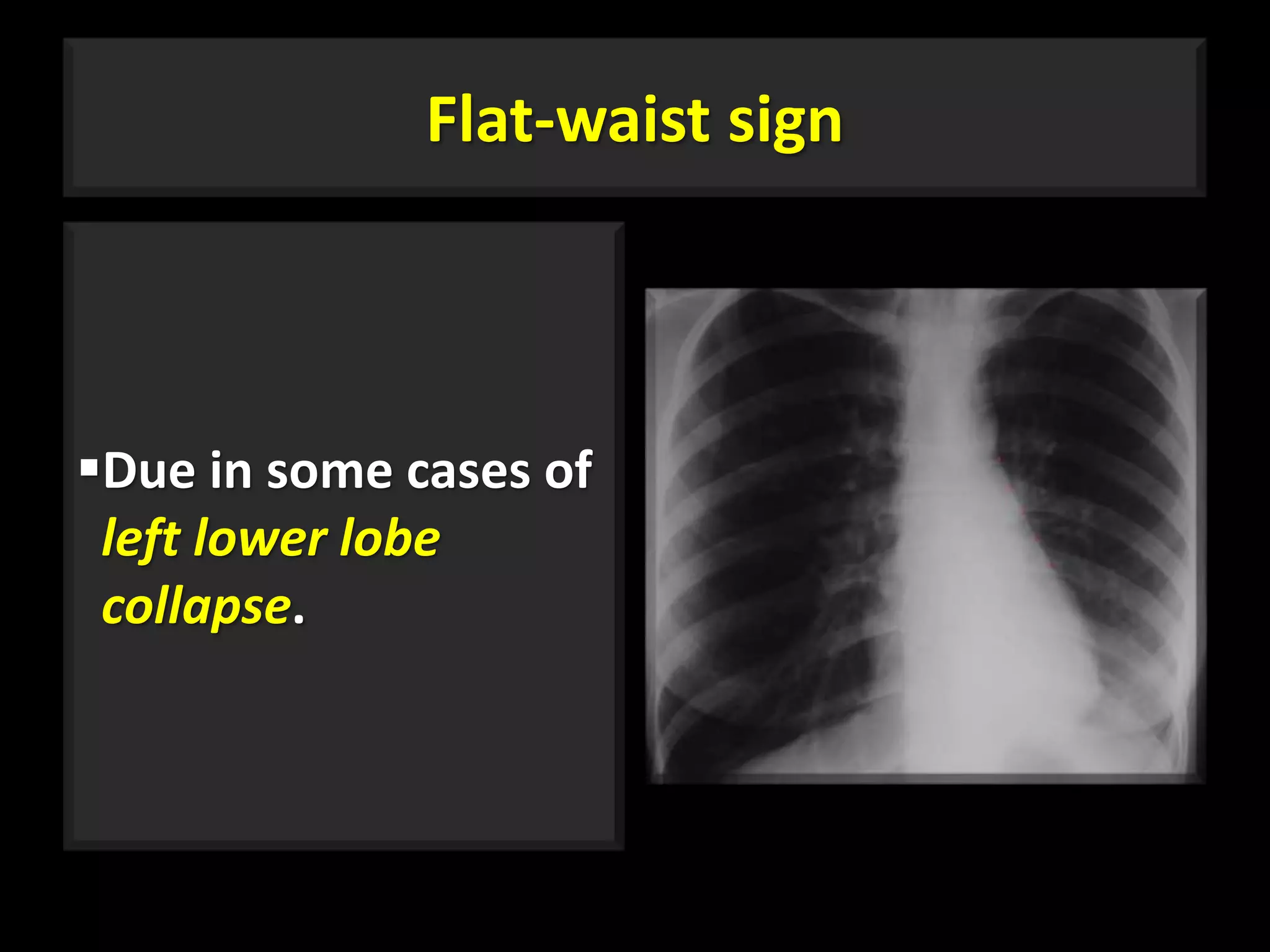 Deep sulcus sign fallen lung sign-ct angiogram sign-flat-waist sign | PPTX