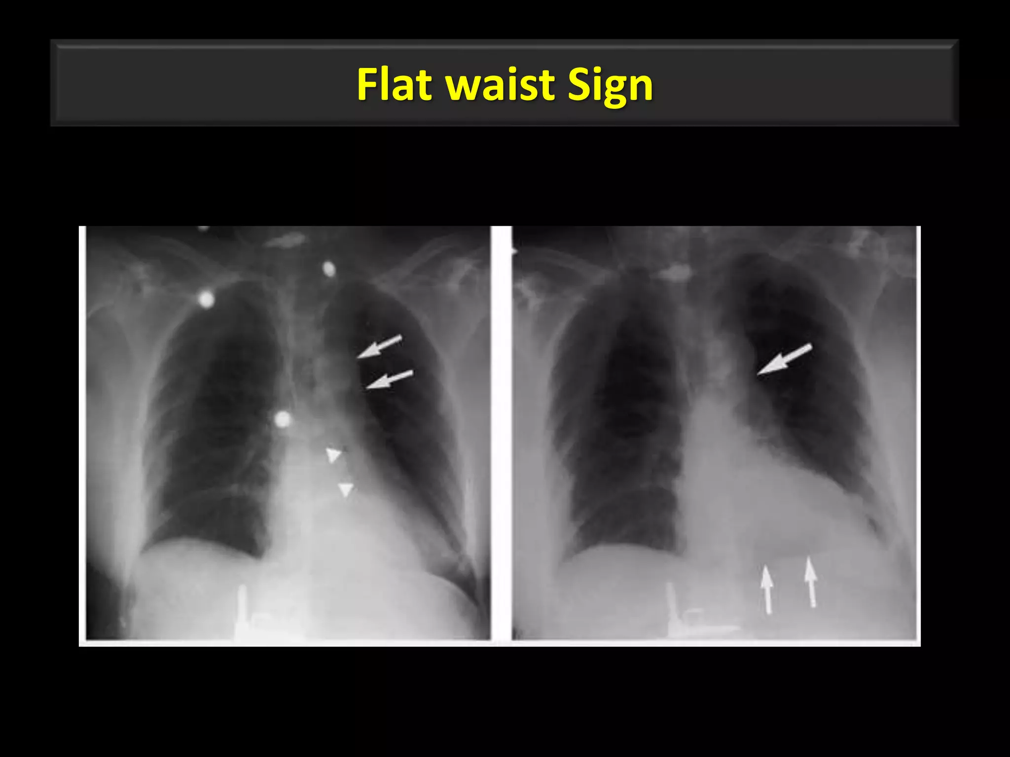 Deep sulcus sign fallen lung sign-ct angiogram sign-flat-waist sign ...
