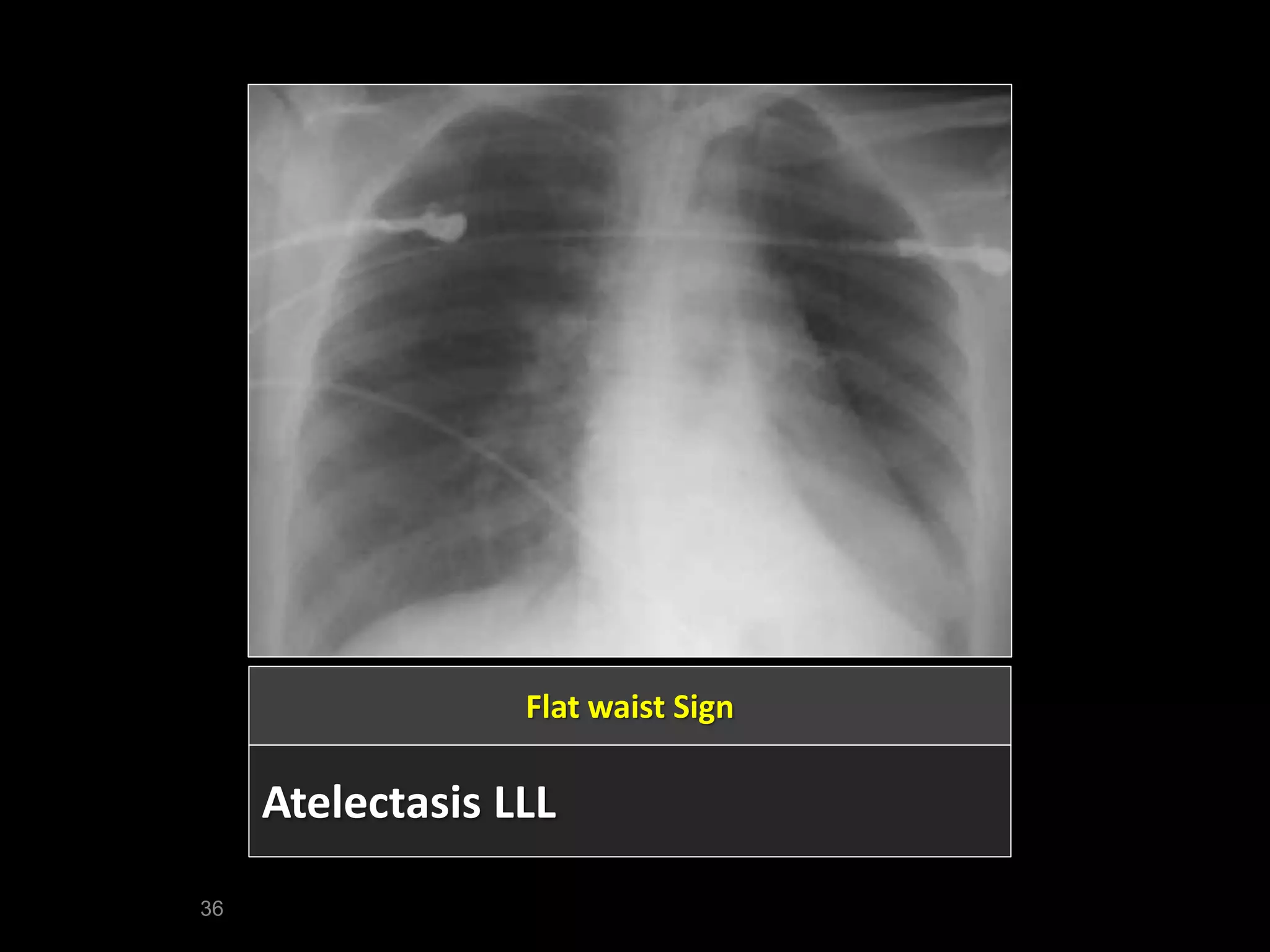 Deep sulcus sign fallen lung sign-ct angiogram sign-flat-waist sign | PPTX