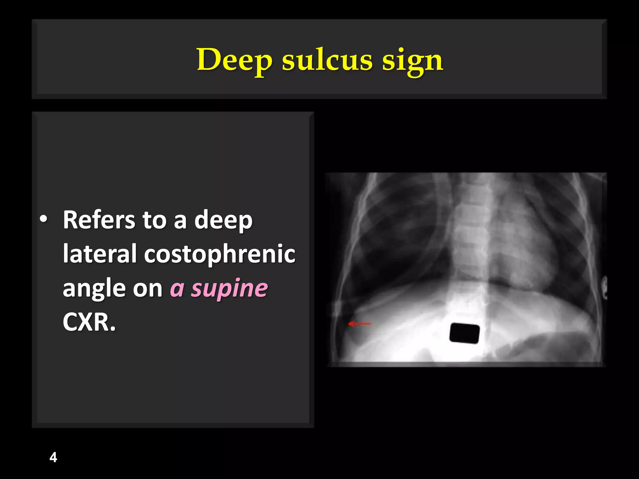 Deep sulcus sign fallen lung sign-ct angiogram sign-flat-waist sign | PPTX