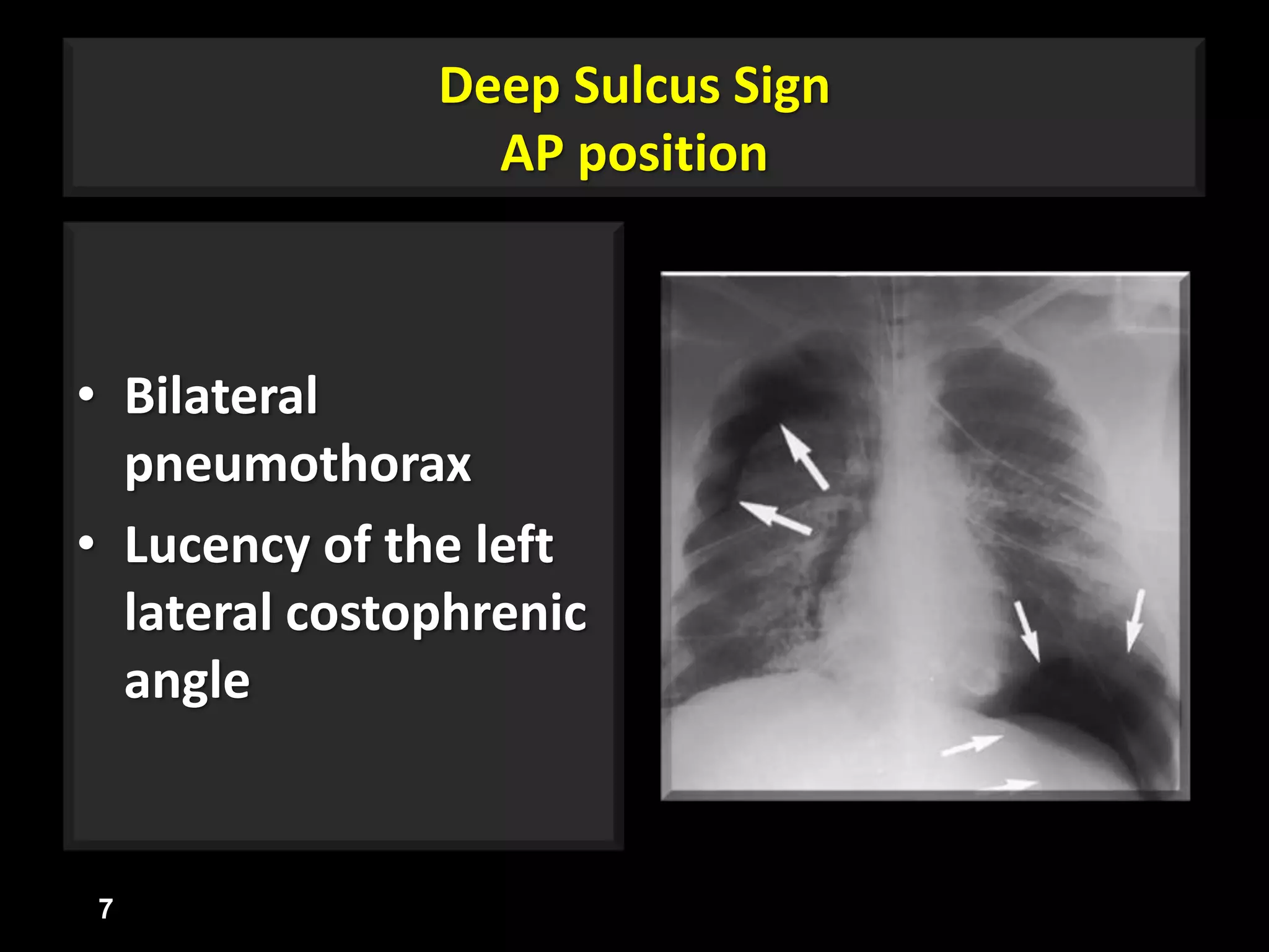Deep sulcus sign fallen lung sign-ct angiogram sign-flat-waist sign | PPTX
