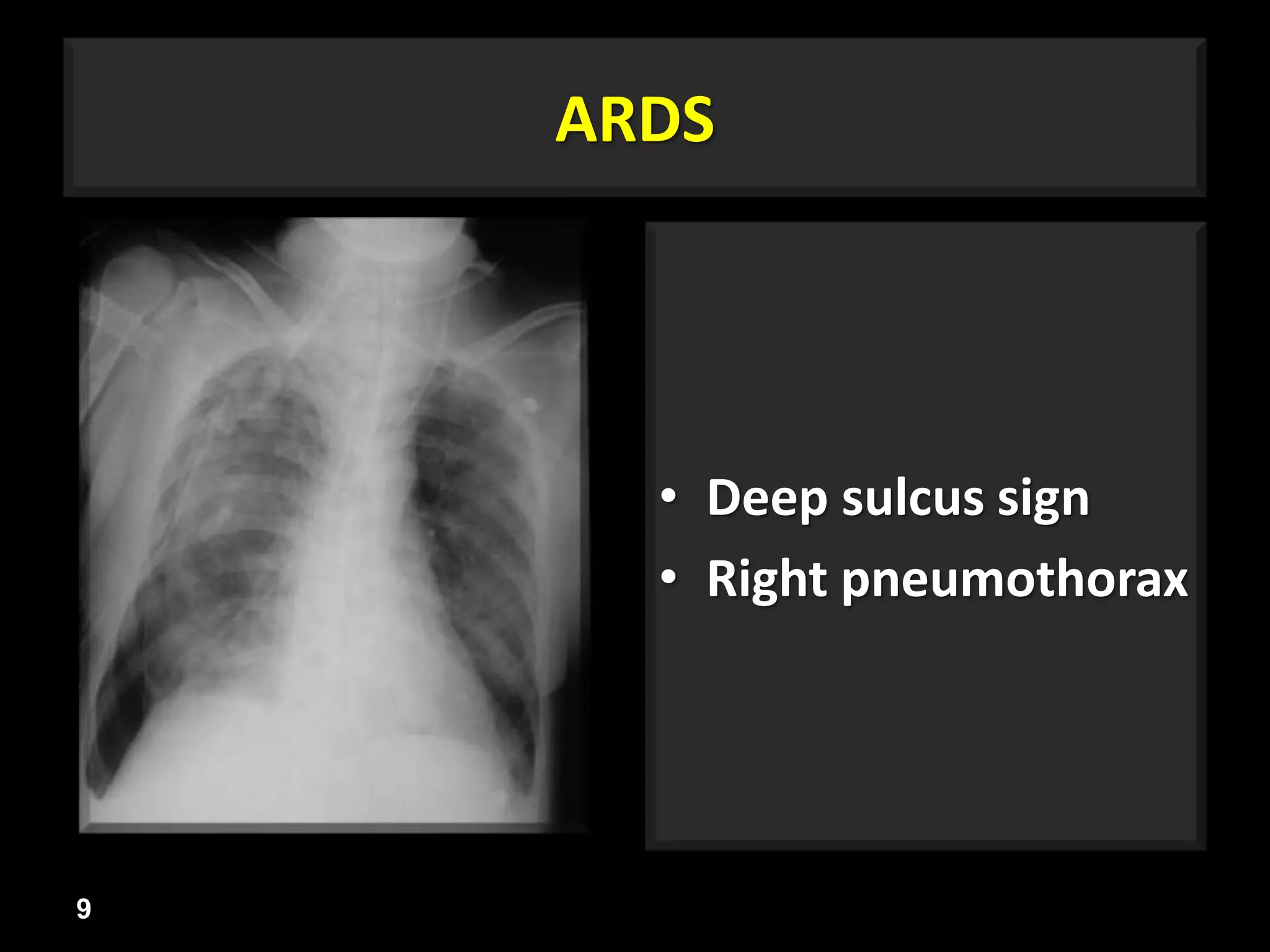 Deep sulcus sign fallen lung sign-ct angiogram sign-flat-waist sign | PPTX