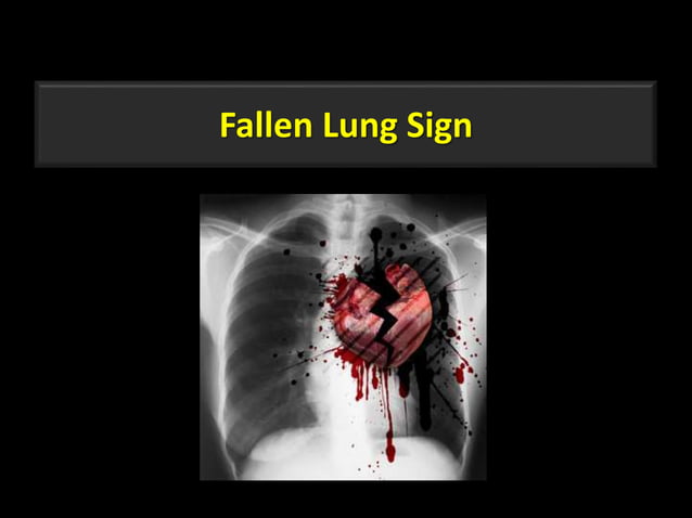 Deep sulcus sign fallen lung sign-ct angiogram sign-flat-waist sign ...