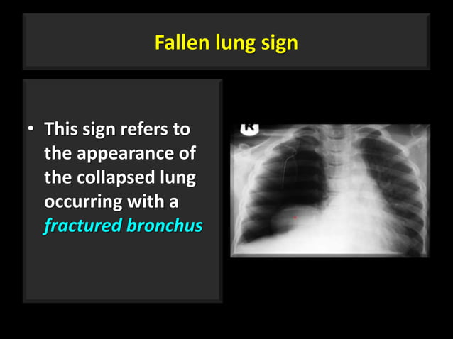 Deep sulcus sign fallen lung sign-ct angiogram sign-flat-waist sign ...