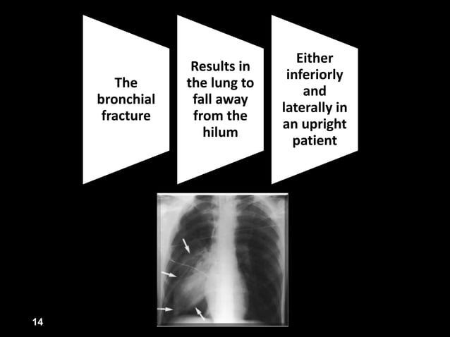 Deep sulcus sign fallen lung sign-ct angiogram sign-flat-waist sign ...