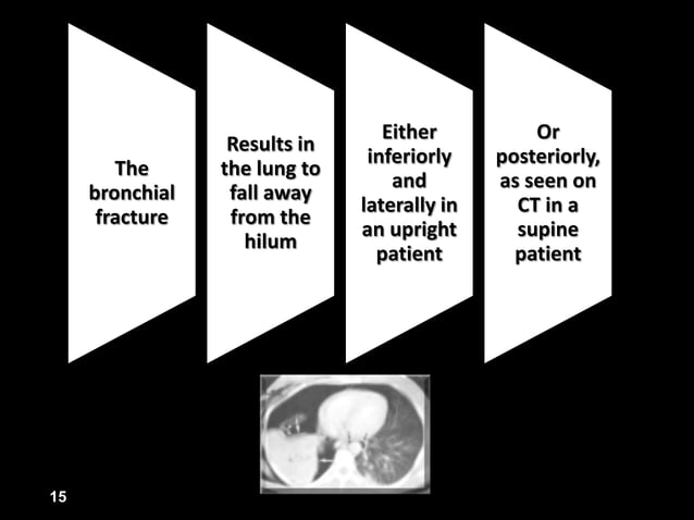 Deep sulcus sign fallen lung sign-ct angiogram sign-flat-waist sign ...