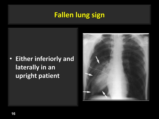 Deep sulcus sign fallen lung sign-ct angiogram sign-flat-waist sign ...