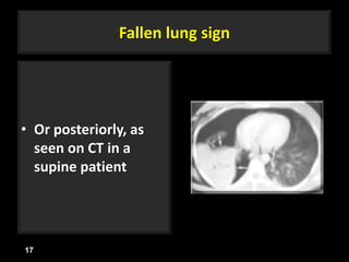 Deep sulcus sign fallen lung sign-ct angiogram sign-flat-waist sign | PPT