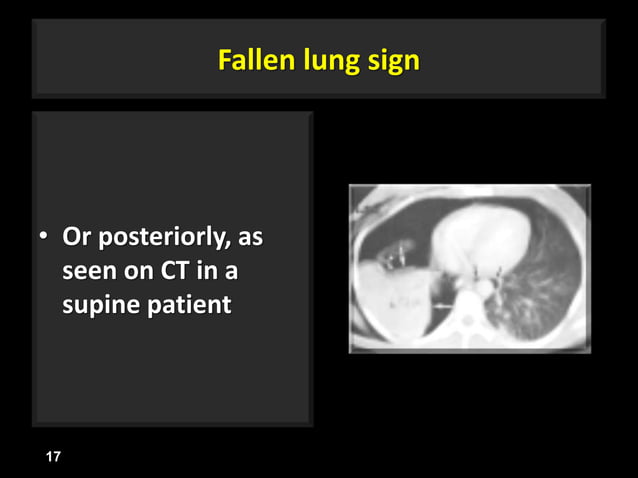 Deep sulcus sign fallen lung sign-ct angiogram sign-flat-waist sign ...
