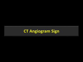 Deep sulcus sign fallen lung sign-ct angiogram sign-flat-waist sign | PPT