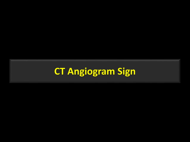 Deep sulcus sign fallen lung sign-ct angiogram sign-flat-waist sign ...
