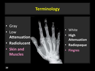 Deep sulcus sign fallen lung sign-ct angiogram sign-flat-waist sign | PPT