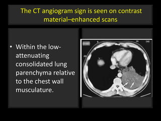 Deep sulcus sign fallen lung sign-ct angiogram sign-flat-waist sign | PPTX