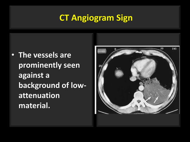 Deep sulcus sign fallen lung sign-ct angiogram sign-flat-waist sign ...