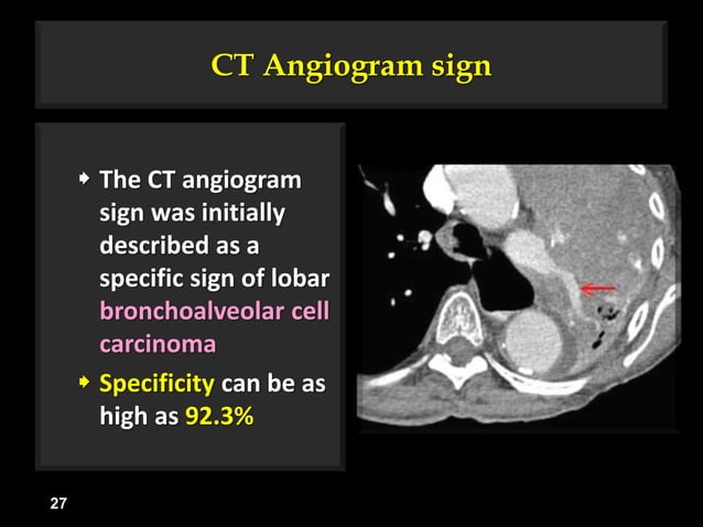 Deep sulcus sign fallen lung sign-ct angiogram sign-flat-waist sign ...
