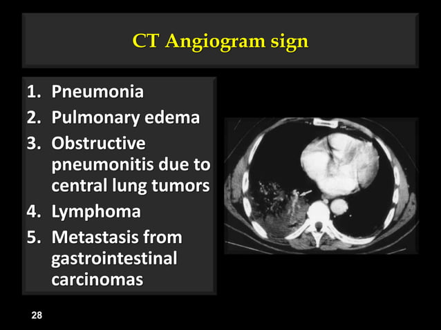 Deep sulcus sign fallen lung sign-ct angiogram sign-flat-waist sign ...