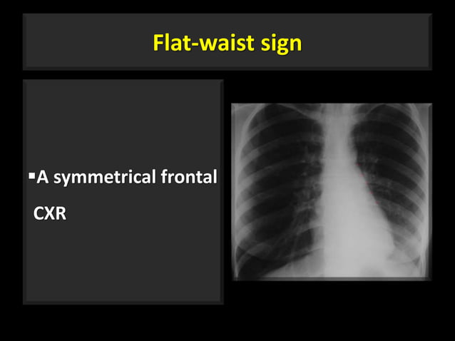 Deep sulcus sign fallen lung sign-ct angiogram sign-flat-waist sign ...