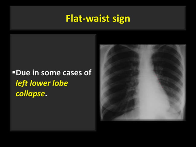 Deep sulcus sign fallen lung sign-ct angiogram sign-flat-waist sign ...